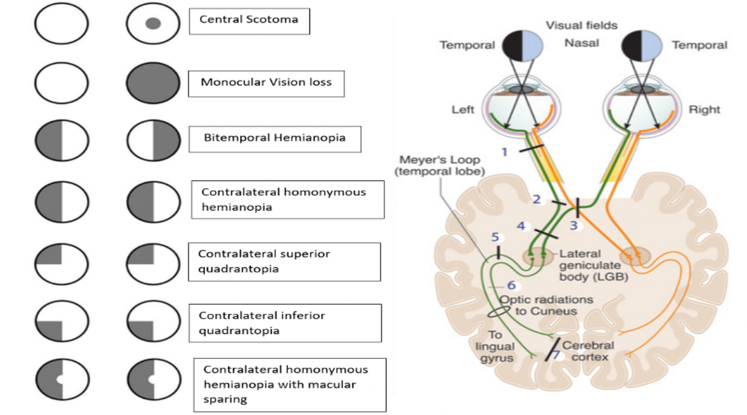Homonymous Hemianopsia: The vision in fragments – The BioTalk Magazine